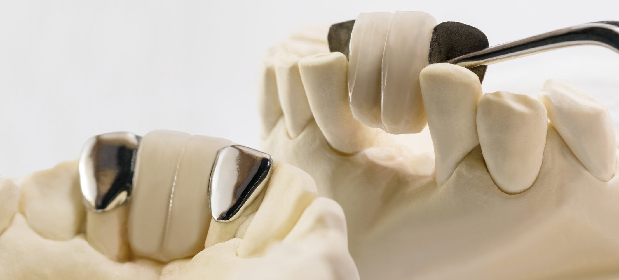 Maryland Bridge: A Minimally Invasive Solution for Beautiful Smiles