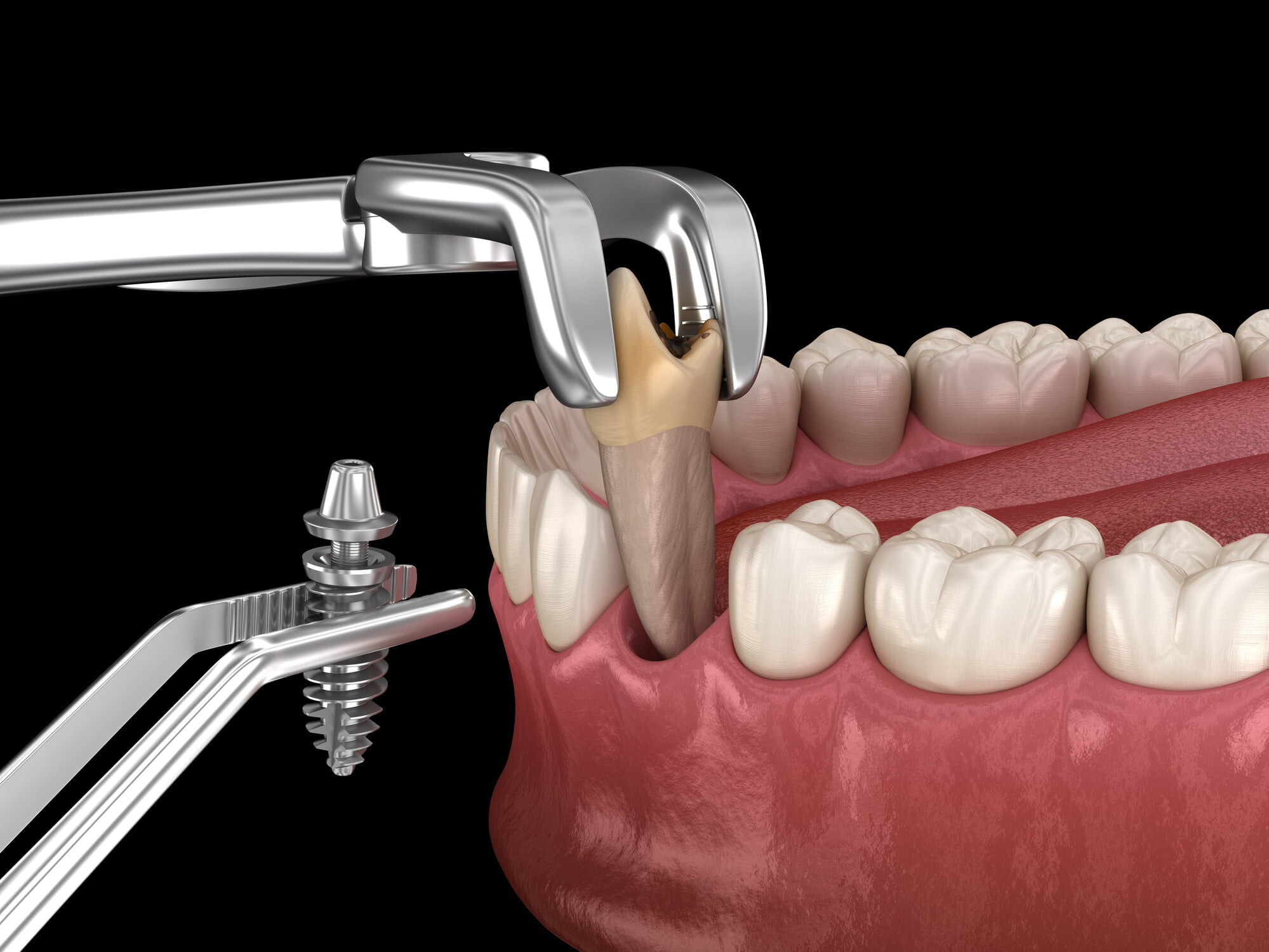 Immediate Implant: What You Need to Know