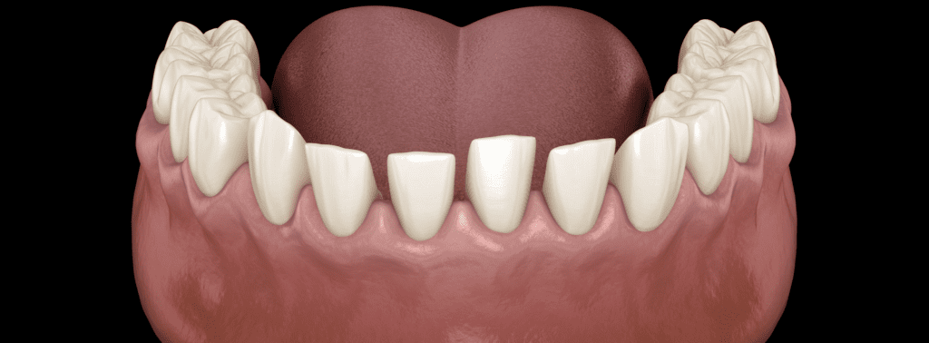 Spacing in Teeth: A Comprehensive Guide