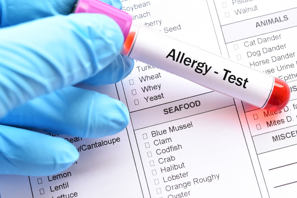 Dental Allergies: Causes, Symptoms, and Treatment Options