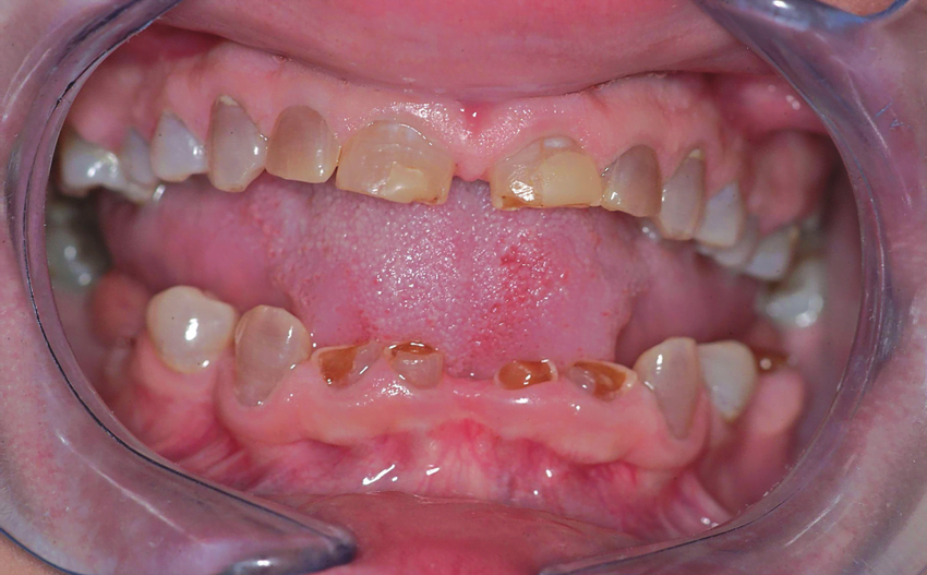 Dentinogenesis Imperfecta: The Genetic Disorder Affecting Dental ...