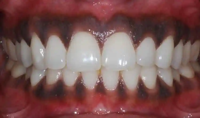 Black Gums: Causes, Symptoms, and Treatment