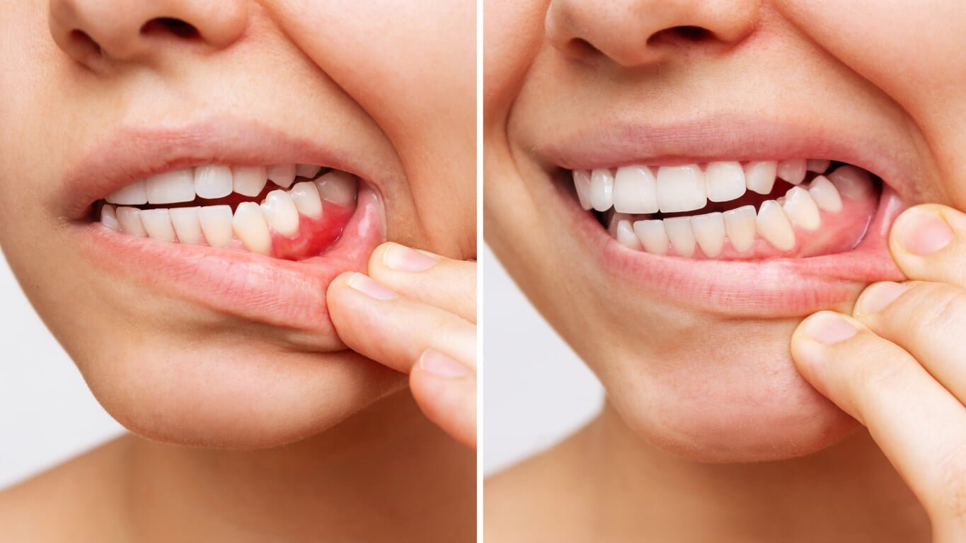 The Definitive Guide to Gum Health