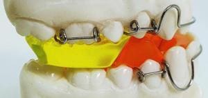 Twin Block Appliance: A Comprehensive Guide