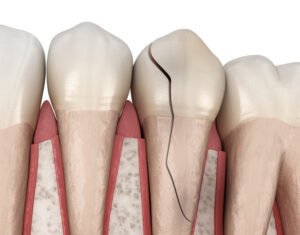 Tooth Fracture: Types, Treatments, and Prevention Strategies