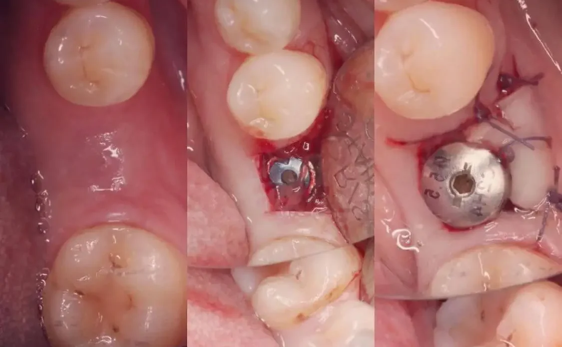 Modified Rolling Flap Technique