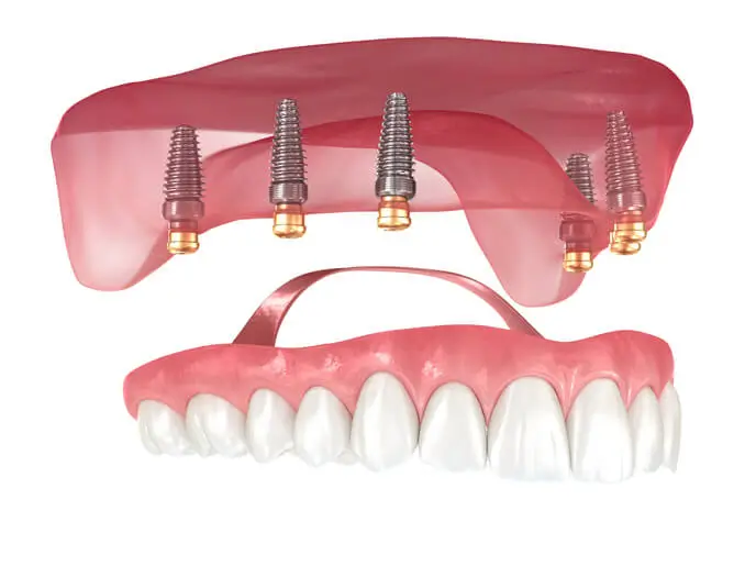 Revitalizing Overdentures: The Essential Locator Attachment