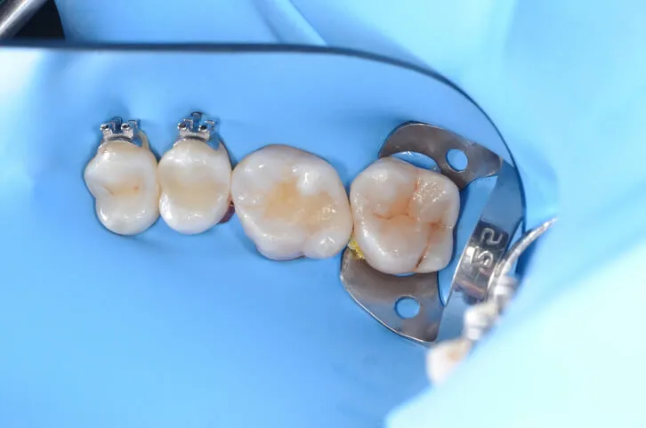 Quality and Longevity of Direct Light-Activated Composite Resin ...