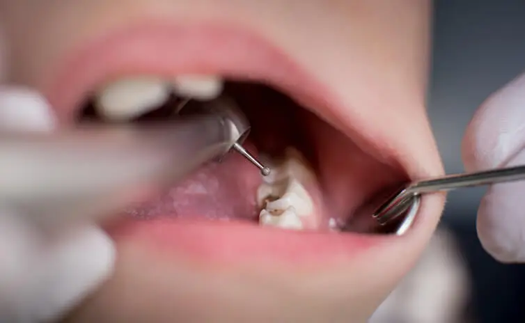 Pulp Capping: A Vital Dental Treatment