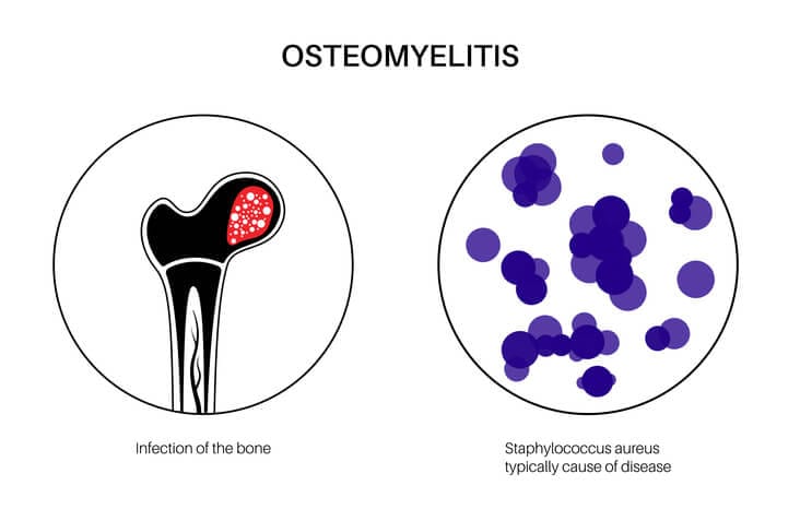 Osteomyelitis: Understanding the Complexities of Bone Infections
