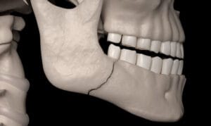 Jaw Fractures: Causes, Symptoms, and Treatment