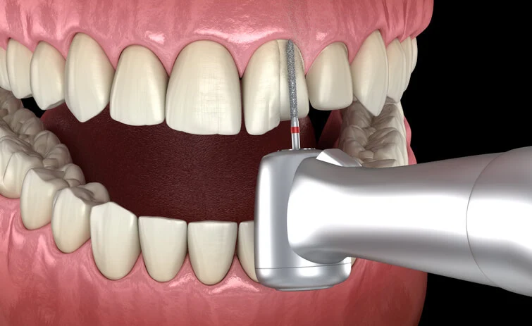 Veneer Preparation: Techinques and Steps