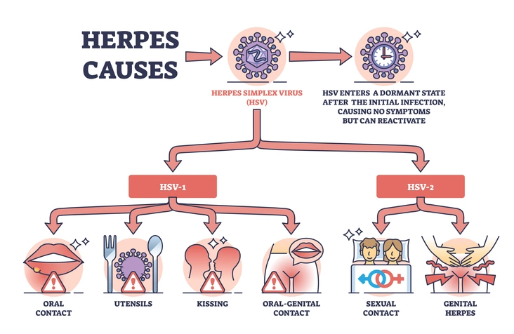 Herpes Simplex Virus (HSV): Symptoms and Treatments