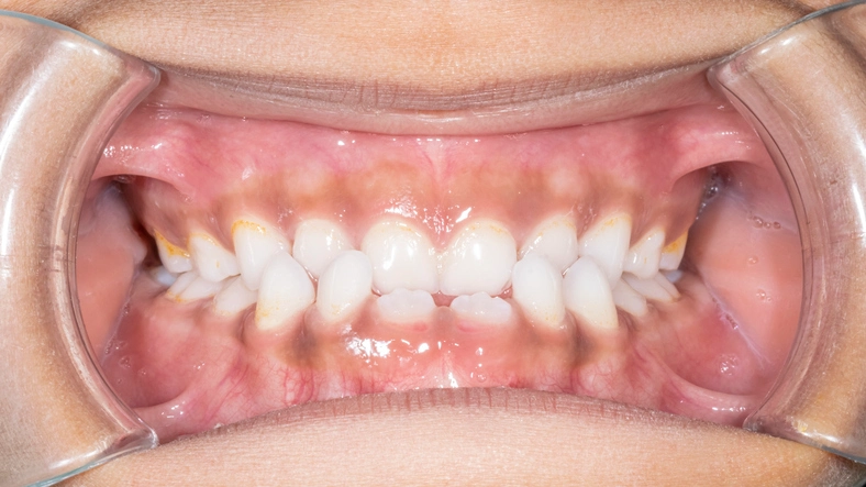 Gingival Depigmentation: Causes and Treatments