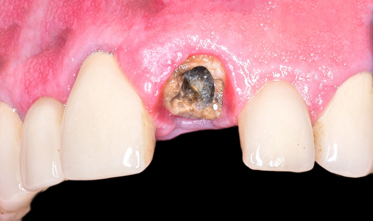 Principles and Techniques for Removal of Retained Roots